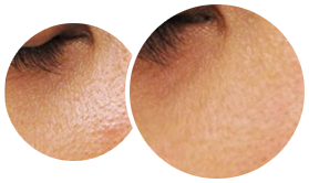 Купить прибор ReadySkin